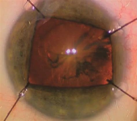 Iris Hooks American Academy Of Ophthalmology