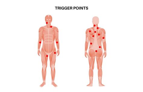 Myofascial Trigger Points Royalty Free Vector Image Myofascial Trigger Points Royalty Free Vector Image