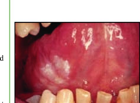 Leukoplakia On The Ventral Surface Of The Tongue Following Excision