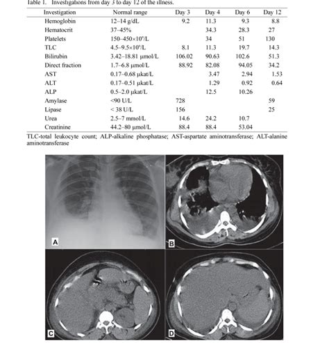 A Chest Radiograph Showing Bilateral Interstitial Infiltrates And Download Scientific Diagram