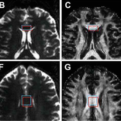 PDF DTI Analysis Methods Region Of Interest Analysis
