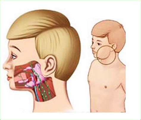 腮腺炎和淋巴结炎图片有来医生