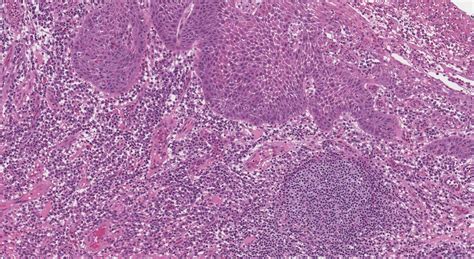 Keratinizing Squamous Dysplasia Of The Oral Cavity Ottawa Atlas Of Pathology