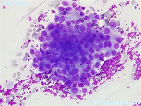 Cholangiocarcinoma Liver Cytology