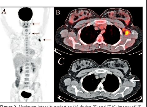 Figure 1 From Kikuchi Fujimoto Disease As A Rare Cause Of Benign Lymphadenopathy And 18f Fdg