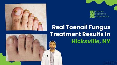 Yellow Thick Or Crumbling Signs Might Have Toenail Fungus