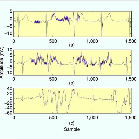 standard ecg features a wandering baseline b motion artifact and