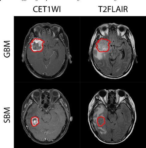 Figure 1 From The Application Of Dtcwt On Mri Derived Radiomics For Differentiation Of