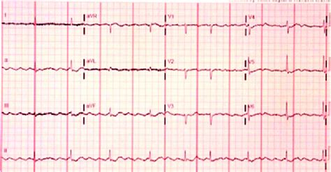 Atrial Flutter With Slow Ventricular Rate Download Scientific Diagram