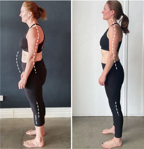 Posture Correction Pain Relief Functional Patterns Brisbane Functional Patterns Brisbane