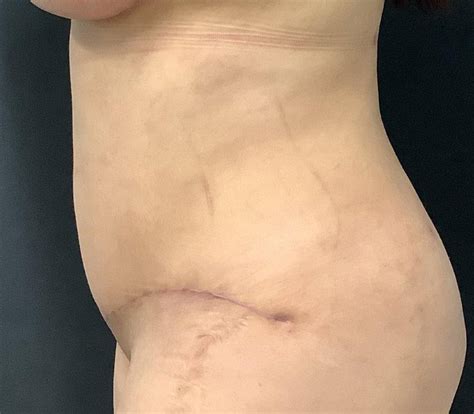 Tummy Tuck And Liposuction Psc Wichita
