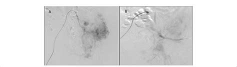 Embolization Of The Left Pelvic Tumor Artery A Before Tumor Artery Download Scientific