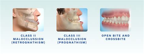 Understanding The Differences Between Skeletal Malocclusion And Dental