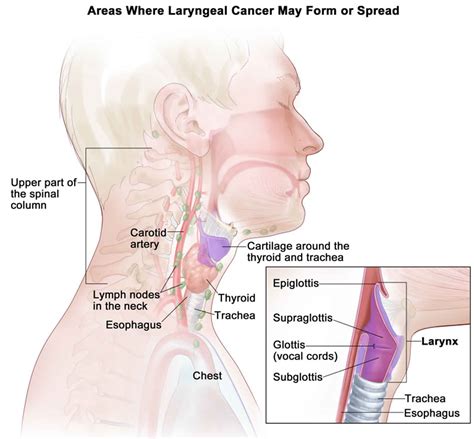 Total Or Partial Laryngectomy Procedure Complications Risks And Recovery