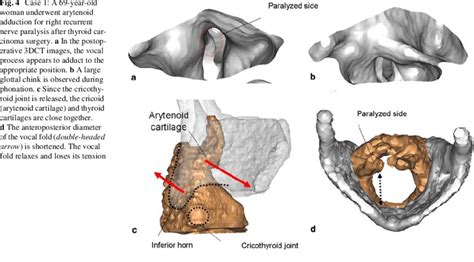 Case 2 A 64 Year Old Man Underwent Type I Thyroplasty For Left Download Scientific Diagram