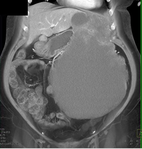 Large Gastric Gist Tumor Stomach Case Studies Ctisus Ct Scanning