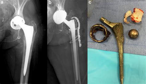A Preoperative Radiograph Of A Catastrophic Polyethylene Liner Wear Download Scientific
