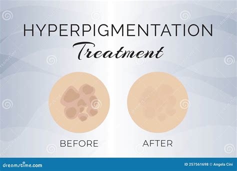 Hyperpigmentation And Melasma Is On The Woman Face Vector Illustration