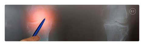 Peeking Inside Your Joints Understanding The Arthrogram — Evolution Imaging