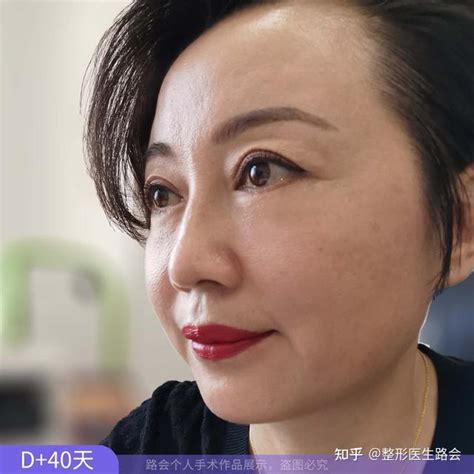 泪沟填充，并不是“打一针”那么简单！ 知乎