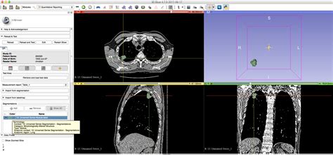 Anatomic Region Modifier Is Not Displayed In Terminology Tooltip Issue Qiicr
