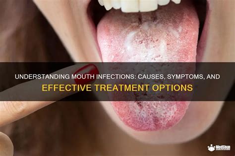 Understanding Mouth Infections Causes Symptoms And Effective