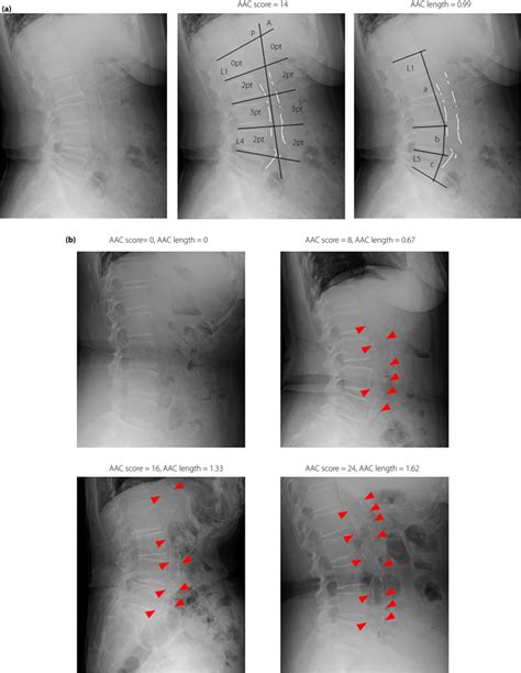 Grading Of Abdominal Aortic Calcification Aac A The Middle Panel
