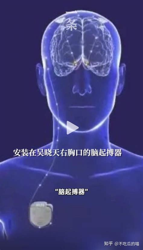 重度抑郁也能开心？脑机接口手术到底有多神奇？ 知乎