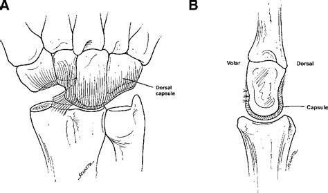 Figure 5 From Proximal Row Carpectomy Semantic Scholar