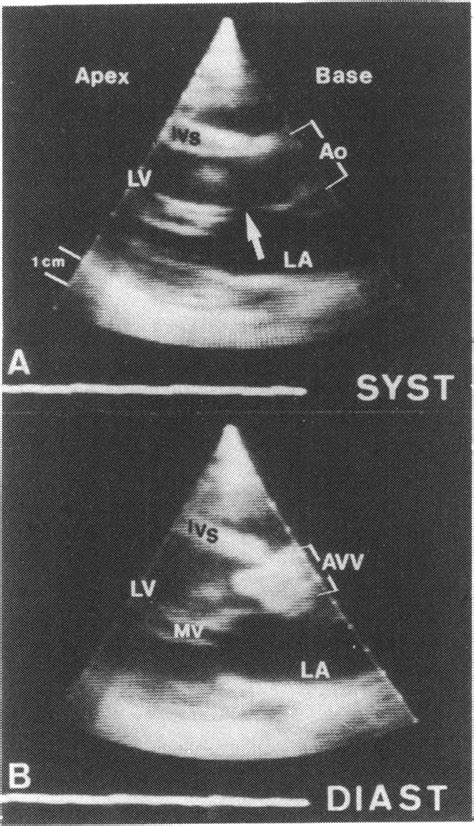 A Long Axis Real Time Two Dimensional Echocardiograms In Systole Download Scientific Diagram