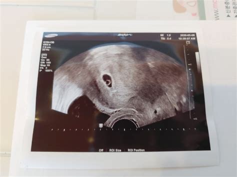 5주6일 첫 초음파사진아기집 확인난황 모양임신초기 네이버 블로그