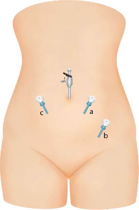 Tips And Tricks In Laparoscopic Surgery Port Placement Melaka Fertility