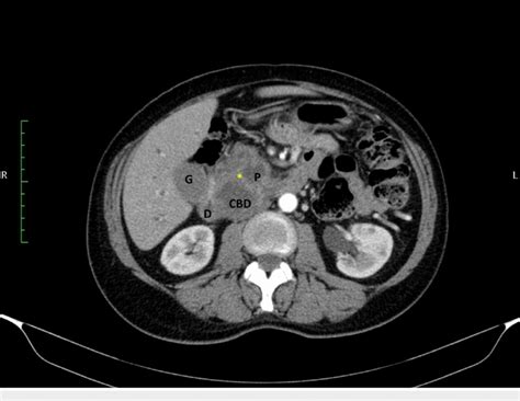 Axial Ct Scan Images Demonstrate A Heterogeneous Mass In The Pancreatic Download Scientific