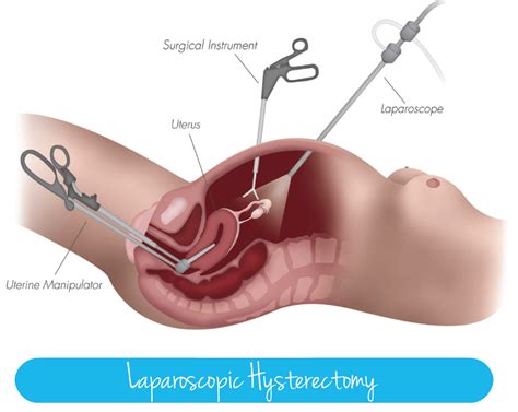 Laparoscopic Abdominal Hysterectomy