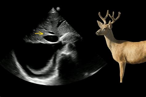 Focused Cardiac Ultrasound For The Nephrologist The Subxiphoid View Renal Fellow Network