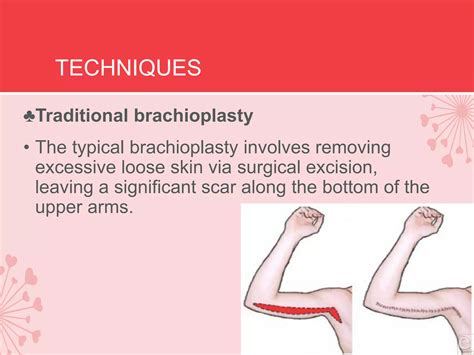 Brachioplasty Pptx
