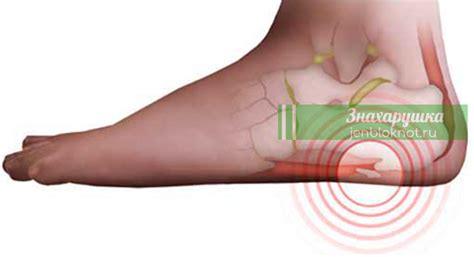 Пяточная шпора эффективное средство для снятия воспаления и боли Знахарушка все о здоровье