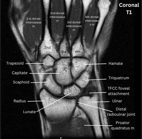 Wrist Anatomy Radiology Anatomy Of Wrist Joint Ppt