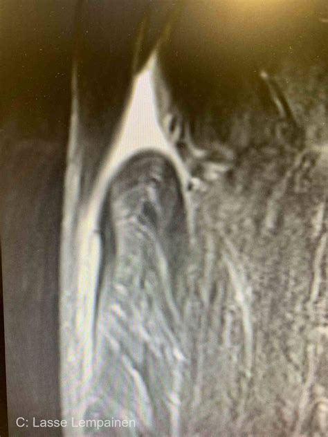 Rectus Femoris Injury Information Urheiluortopedi Lasse Lempainen
