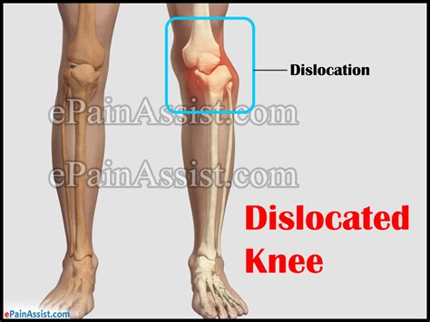 Knee Dislocation Or Dislocated Knee Treatment Diagnosis Risk Factors Complications