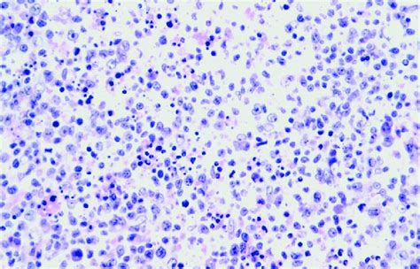 Complete Effacement Of The Lymph Node Architecture By A Polymorphous Download Scientific