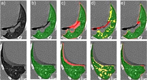 Sample Lung Segmentations On A Representative Slice A Corresponding