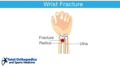 What Are The Signs You Should See A Wrist Fracture Doctor Immediately
