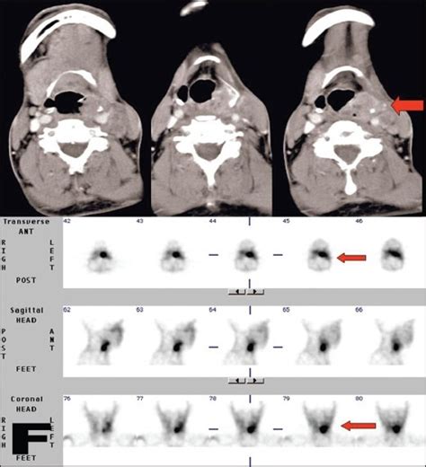 A 53 Year Old Male A Case Of Carcinoma Of Pyriform Fossa And Base Of Download Scientific