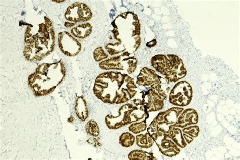 Ai Based Tool Promises Improved Treatment For Patients With Dcis Of The Breast Winship Cancer