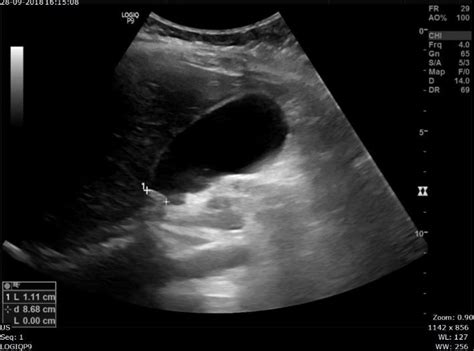 Gall Bladder Is Well Distended Wall Of Normal Thickness An Echogenic