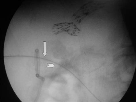 Digital Subtraction Fluoroscopy Image Shows Passage Of A 10 F Arterial