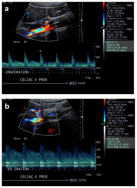 A Doppler Ultrasound Obtained From A Different Patient With Mals Download Scientific Diagram