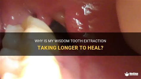 Why Is My Wisdom Tooth Extraction Taking Longer To Heal Medshun