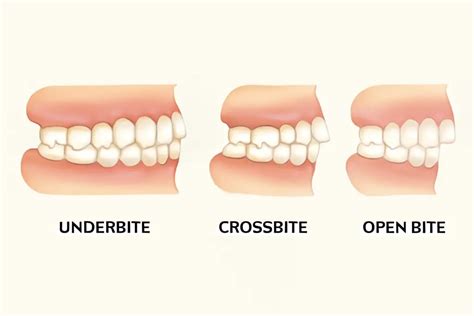 What Your Bite Says About Your Health Lema